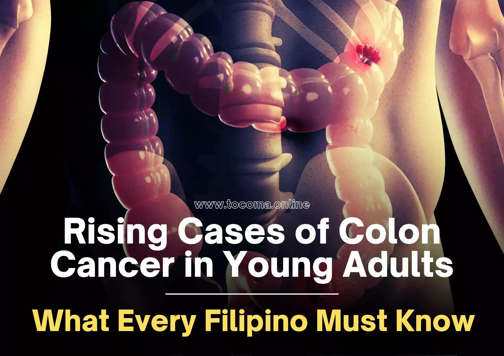 Rising Colon Cancer in Young Adults: What Every Filipino Should Know